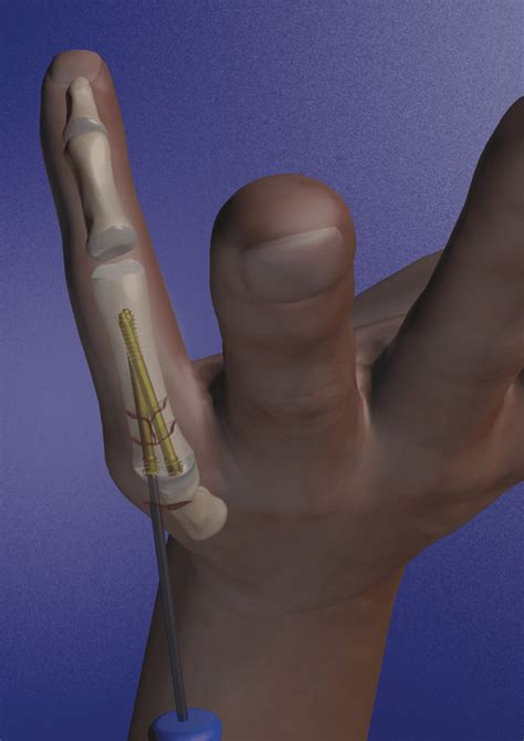 Dual Anterograde Proximal Phalanx Fixation Proximal Phalanx Y Strutting Download