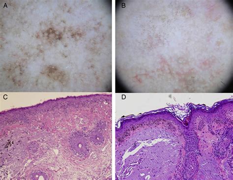Lentigo Maligna Actas Dermo Sifiliográficas