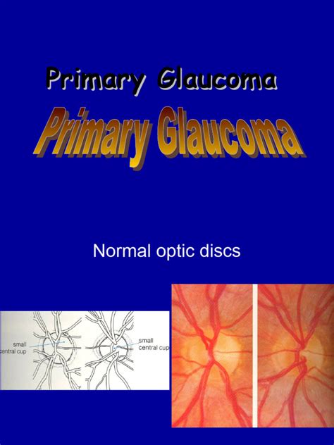 8 Primary Glaucoma Pdf