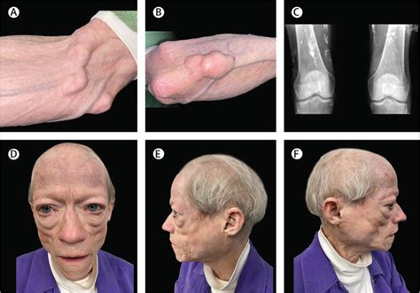 Lipodystrophy In Juvenile Onset Dermatomyositis The Lancet Rheumatology