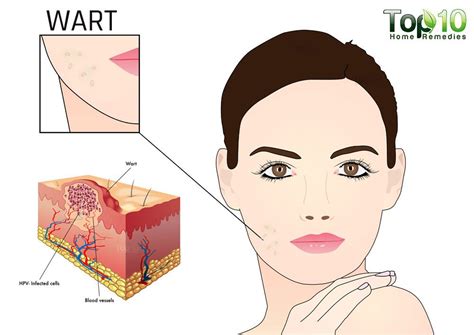 How To Get Rid Of Flat Warts On Lips