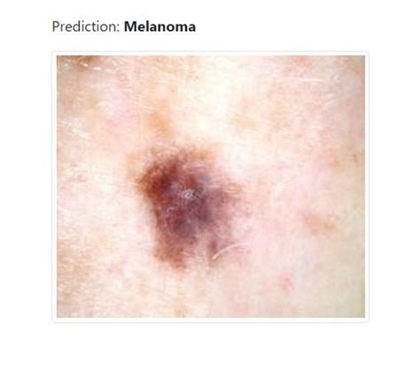 Automated Non Invasive Skin Cancer Detection Using Dermoscopic Images