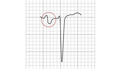 Ecg Part Vi The P Wave