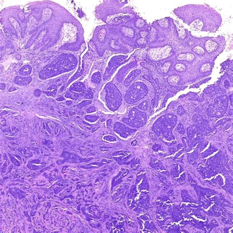 Hisham H Alshuaibi On Linkedin Basaloid Scc ⭐️rare Distinct Variant Of Scc Showing Predominantly…