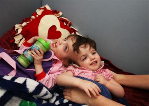 Krista And Tatiana Hogan Biography Canadian Sisters Conjoined Twins