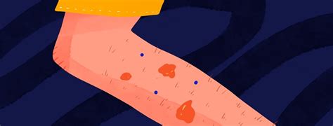 Types Of Allergy Tests And How They Work Asthma Net