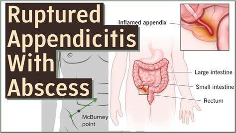 Ruptured Appendicitis What Can Happen If Your Appendix Bursts