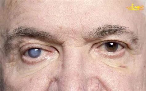 چه بیماری موجب نابینایی می شود