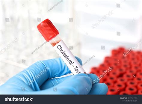 Cholesterol Test Look Abnormalities Blood Blood Stock Photo 2227317393 Shutterstock