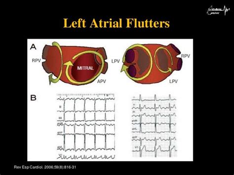 Ablation Of Atypical Flutter Ablation Of Atypical Flutter