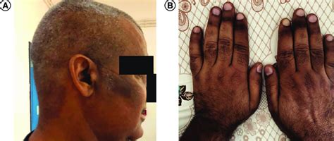 Hyperpigmentation At Presentation A Of The Face B And Hands