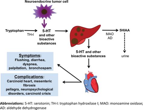 Carcinoid Syndrome Openanesthesia
