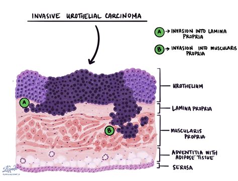 Your Pathology Report For Urothelial Carcinoma Mypathologyreport