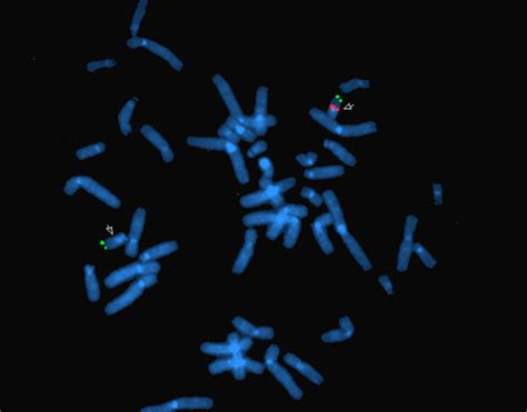 Fish Analysis Of The Proband Using A Probe Labeled Red Specific For