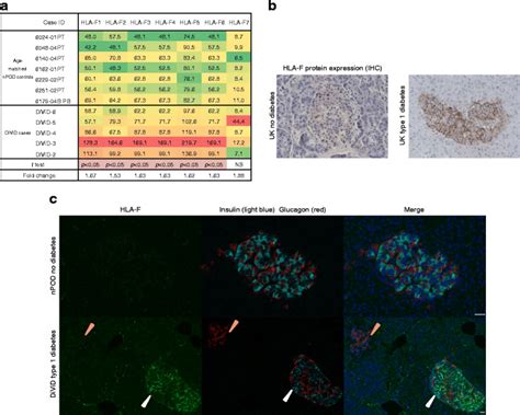 expression of hla f in control individuals and type 1 diabetes