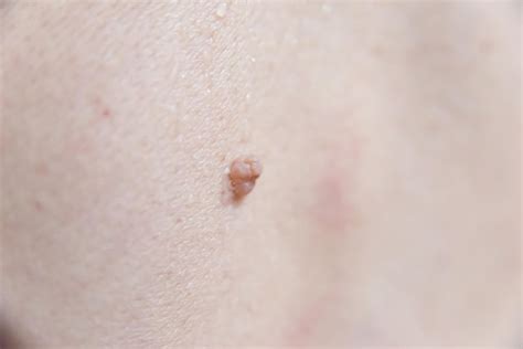 Premium Photo Flesh Mole On Light Skin Woman Mole Disease
