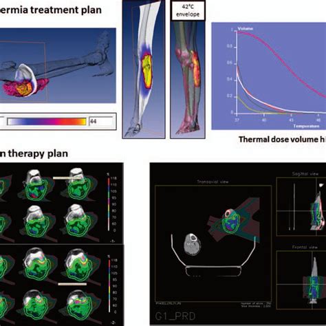 Patient 2 With Undifferentiated Pleomorphic Sarcoma Of The Left Lower Download Scientific