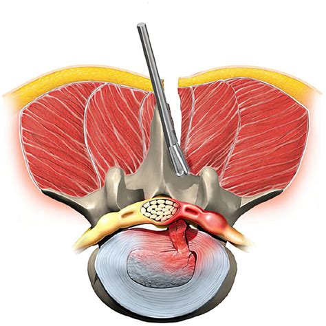 Lumbar Micro Discetomy Trimed Spine And Joint