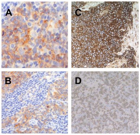 PD L Expression And A High Tumor Infiltrate Of CD Lymphocytes Predict Outcome In Patients