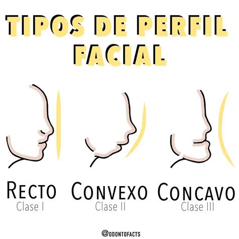 Perfil Facial Recto Cóncavo Y Convexo En Ortodoncia Ortodoncia Junin