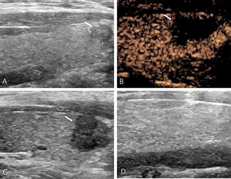 Frontiers Prediction Of Ablation Zone Disappearance After Microwave Ablation For The Patients