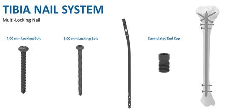 Tibial Tibia Nail System Ml Tibial Tibia Nail System Ml