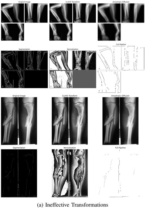 论文审查 Bone Fracture Classification Using Transfer Learning