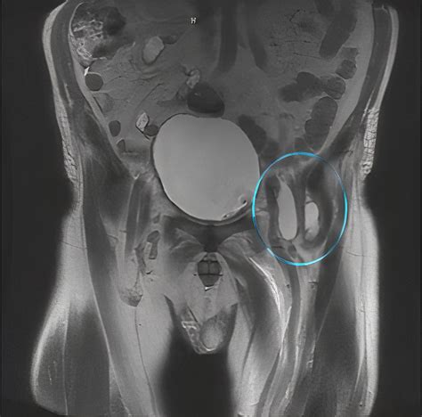 Septic Arthritis Caused By Perirectal Abscess Pmc