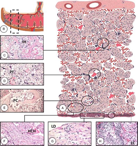 Microscopic Evaluation Of The Placenta A Parenchyma Showing The