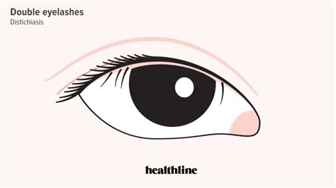 Distichiasis Bij Mensen