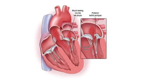 Minimally Invasive Mitral Valve Repair