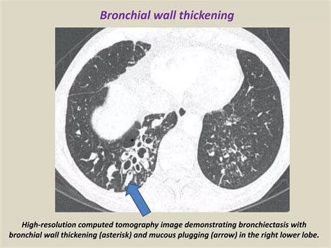Presentation1pptx Radiological Imaging Of Bronchiectasis Pptx