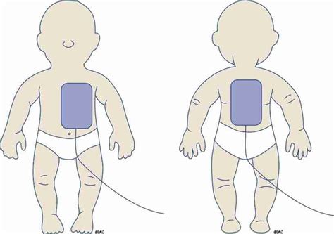 Cómo Usar Un Dea Ante Un Paro Cardiaco Guía Erc 2025 Clara Y