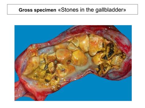 Diseases Of The Liver Pancreas And Gallbladder 1 Ppt