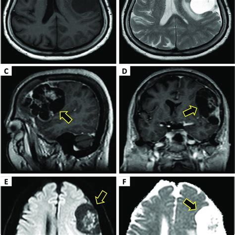 Computed Tomography Ct Scan With A Axial Ct Without Contrast B Download Scientific