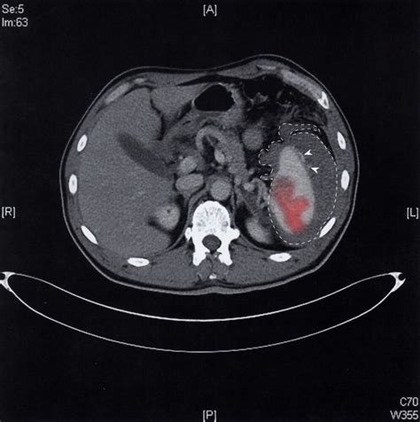 Spleen Rupture Ruptured Spleen Causes Symptoms Treatment Recovery