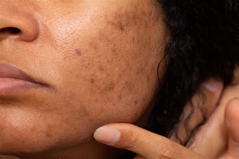 Melasma Solutions Fade Hyperpigmentation And Embrace Even Skin At Smart