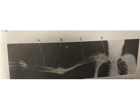 Ir Upper Ex Arteriogram W Occlusion Fig 1 Quiz
