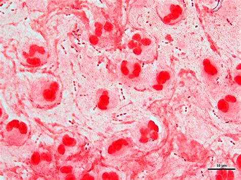 Streptococcus Pneumoniae Gram Stain