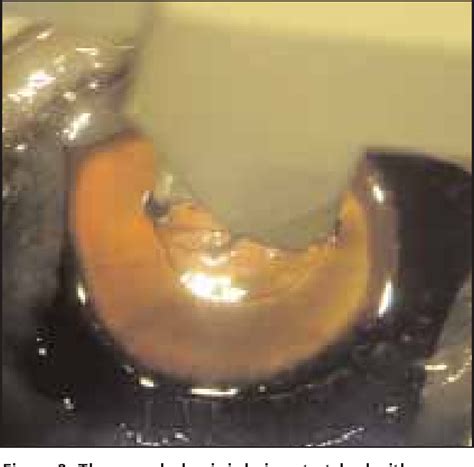 Pdf Tips For Capsular Staining Using Visionblue Improves The Safety