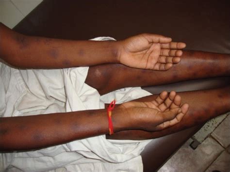 Erythema Nodosum Pictures New Health Advisor