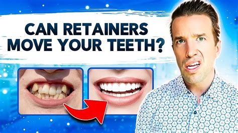 Can Retainers Cut Your Mouth At Laura Stanley Blog