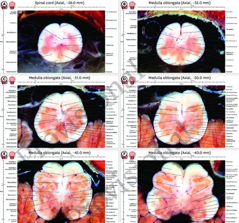 Posterior Median Sulcus Medulla
