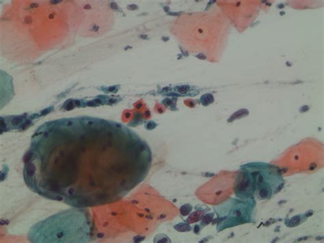 Cervical Cancer Instance Segmentation Instance Segmentation Dataset By