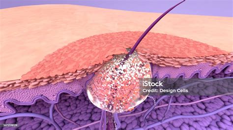 피부 여드름이나 여드름의 형성 막힌 모공의 피지는 특정 박테리아의 성장을 촉진합니다 인간의 피부층 표피 진피 피하 및 근육