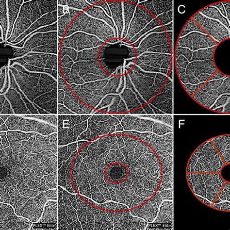 Correlation Between Average Radial Peripapillary Capillary Vessel