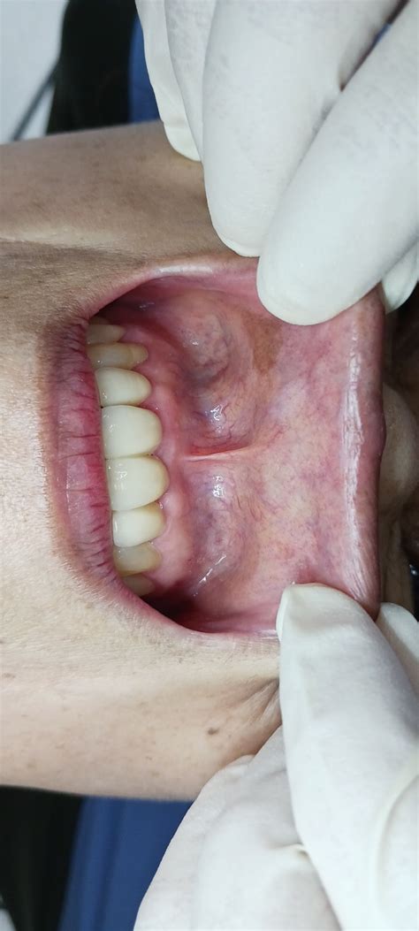 Oral App Object Detection Dataset By Mouth Detection