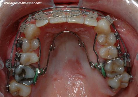Orthodontic Corner Class Ii Div 2 Deep Bite Where Is The Limit