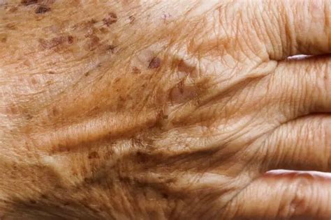 Manchas En Las Manos Causas Y Tratamiento Neutrogena®