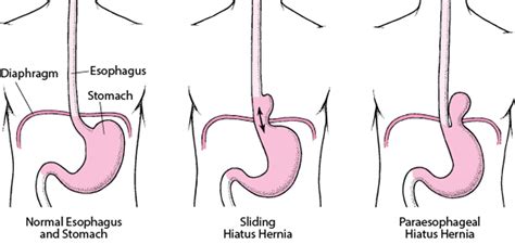 Imageunderstanding Hiatus Hernia Merck Manual Consumer Version